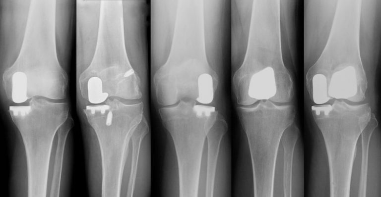 NYC Robotic Partial Knee Replacement | Mako Knee Surgery | UES