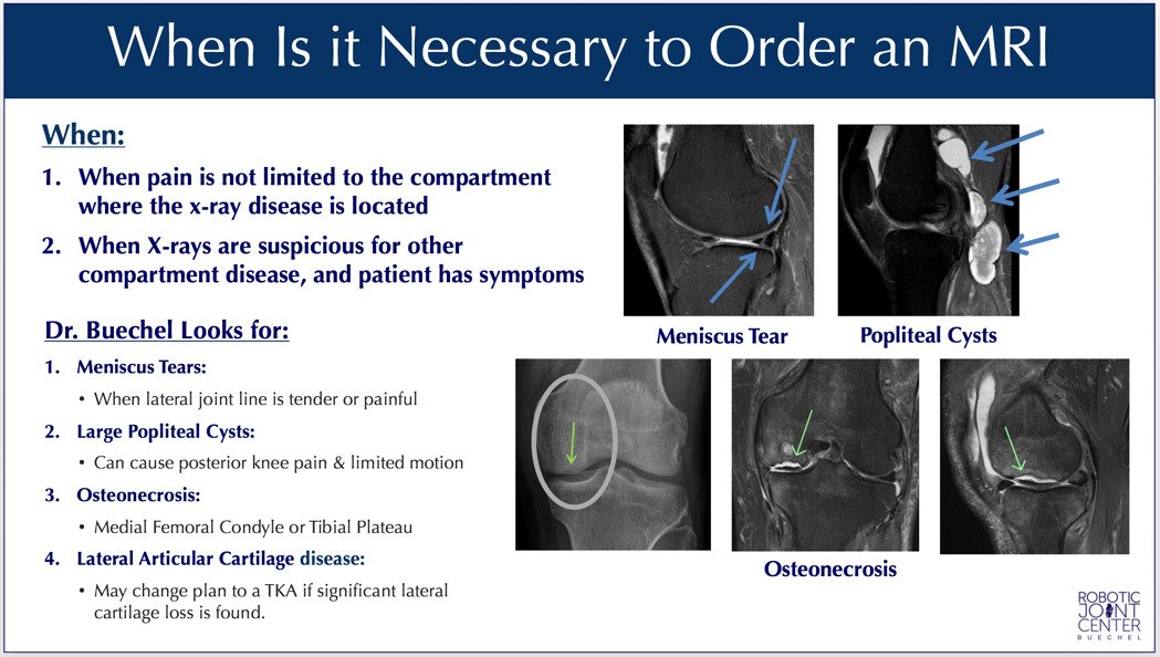 NYC Mako Robotic Partial Knee Replacement | Dr. Frederick Buechel, Jr.