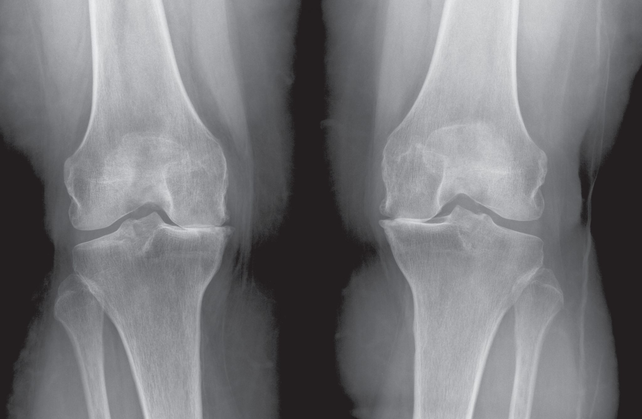 NYC Medial Partial Knee Replacement | Robotic Partial Knee Replacement