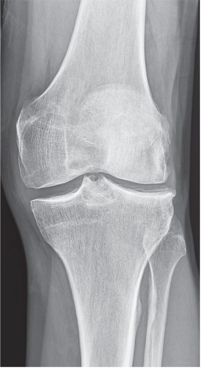NYC Lateral Partial Knee Replacement | Robotic Partial Knee Replacement