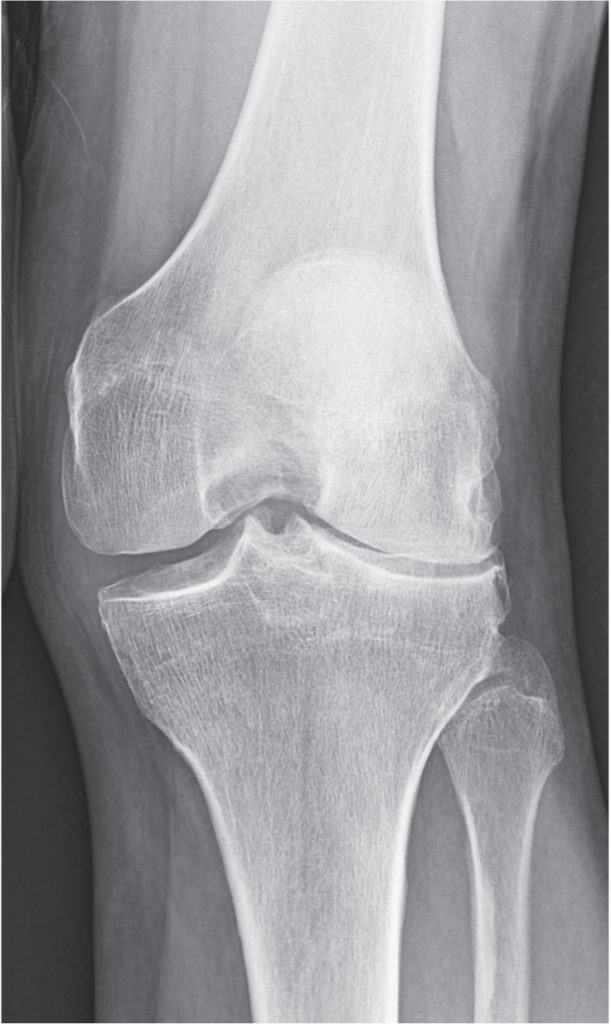 NYC Lateral Partial Knee Replacement | Robotic Partial Knee Replacement