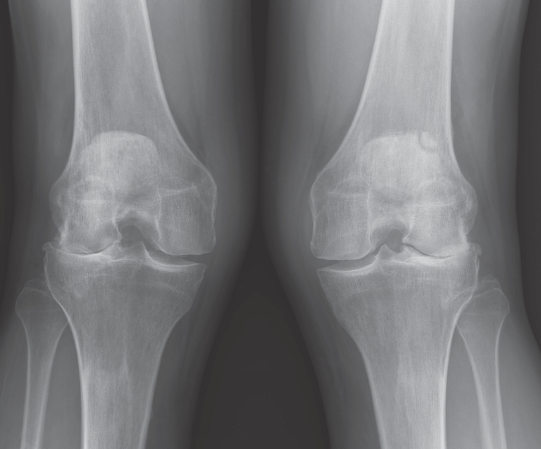 NYC Lateral Partial Knee Replacement | Robotic Partial Knee Replacement
