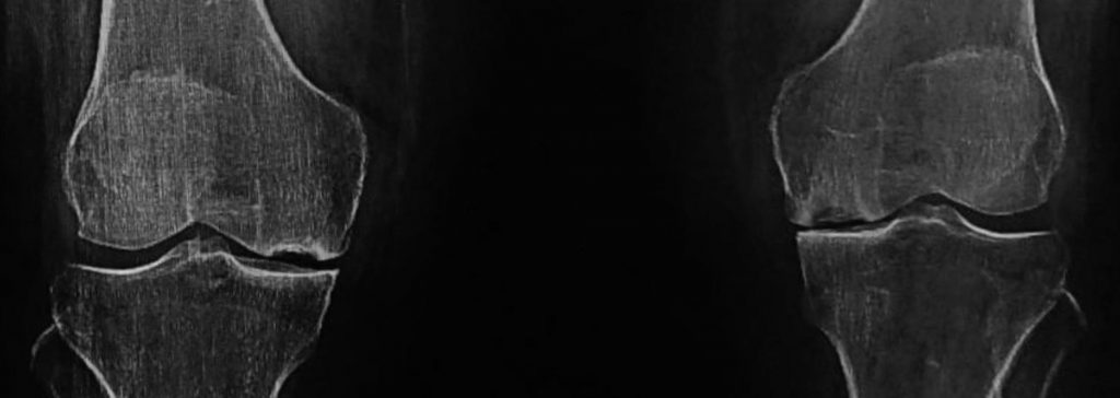 Knee Anatomy Dr. Frederick Buechel, Jr. NYC | Anatomy of the Knee Joint