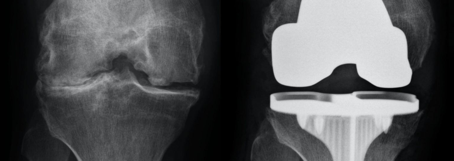 Naples Mako Robotic Total Knee Replacement | Dr. Frederick Buechel, Jr.