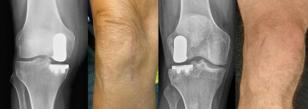 NYC Makoplasty Partial or Total Knee Replacement | Mako Robotic Knee ...