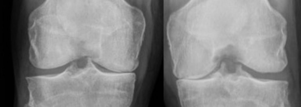 NYC Mako Robotic Partial Knee Replacement | Dr. Frederick Buechel, Jr.